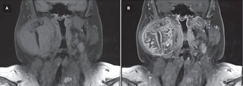 Chondroblastic Osteosarcoma Of The Mandible Applied Radiology