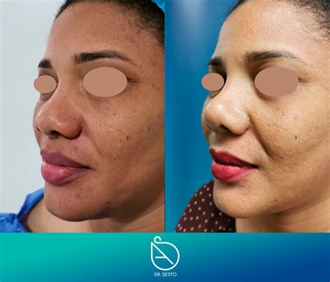 Rinoplastia Dr Adolfo Sesto