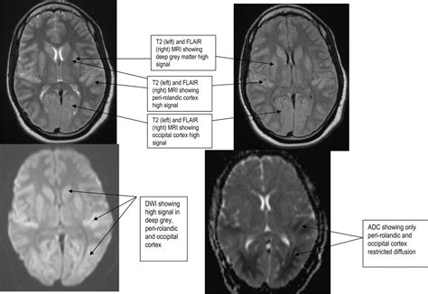 Hypoxic Ct Scan