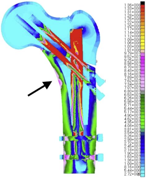 Higher Stress Values Were Measured At Calcar Femoral Black Arrow Download Scientific Diagram