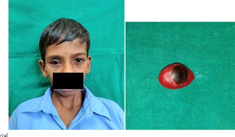 Figure 7 From Prosthetic Rehabilitation Of An Ocular Defect A Case Report Semantic Scholar