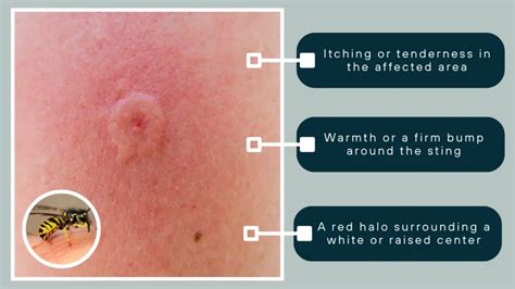 Yellow Wasp Sting Symptoms Treatment And When To Worry