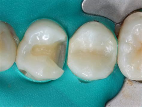 Clinical Guide Class Ii Restoration Of First Premolar With