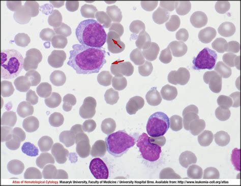 B Cell Prolymphocytic Leukaemia Cell Atlas Of Haematological Cytology