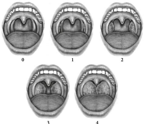 Pdf Correlation Between Brodsky Tonsil Scale And Tonsil Volume In