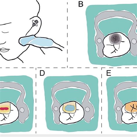 Schematic Representation Of A Ultrasound Guided Trigeminal Nerve