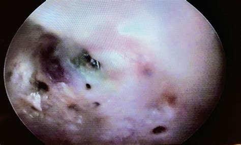 How To Remove Aural Polyp With Flexible Fiber Co2 Laser