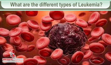What Types Of Leukemia Are Curable Unlocking Hope
