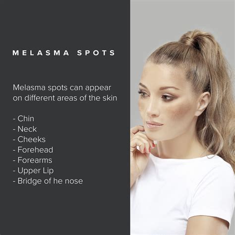 The Melasma Kit Did You Know That Melasma Spots Can Appear On