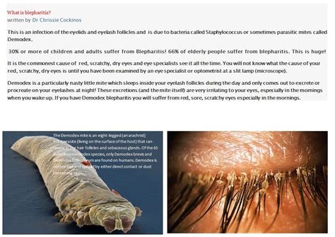 False Eyelashes Blepharitis At Hayley Savige Blog