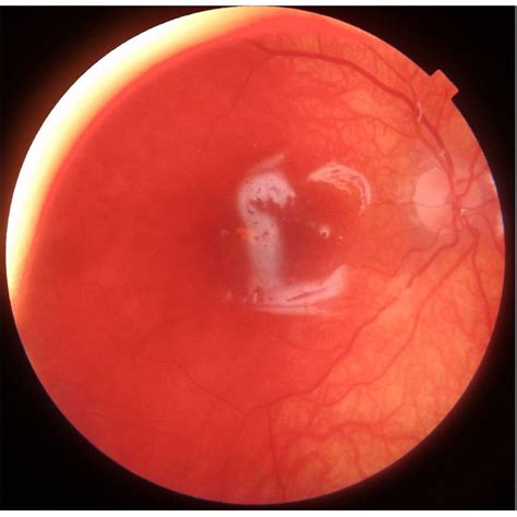 Pattern Visual Evoked Potential Vep And Pattern Electroretinography Download Scientific