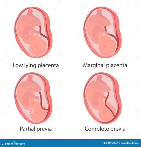 Four Types Of Placenta Previa Concept Illustration Cartoon Vector