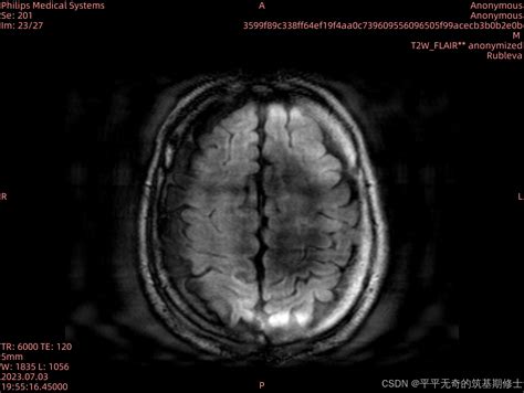 3d Mri运动伪影模拟 一个二维的mr图像如何模拟伪影 Csdn博客