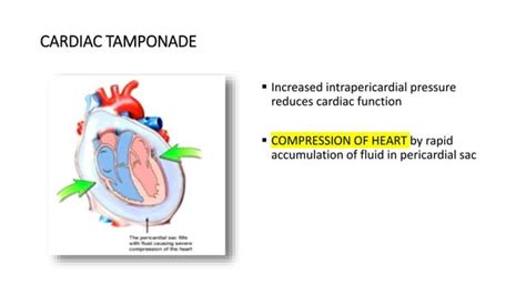 Echocardiography In Cardiac Tamponade Pptx