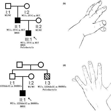 Three Smad6 Mutant Rus Families With Axial Skeletal Malformations A