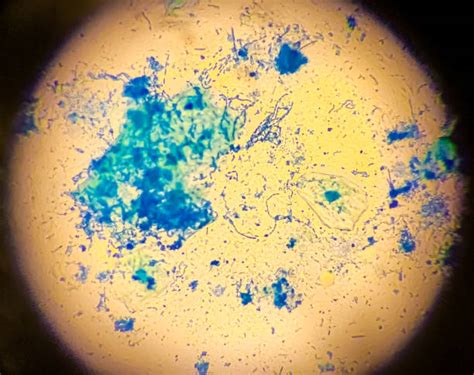 80 Infection A Streptocoques Photos Taleaux Et Images Libre De Droits Istock