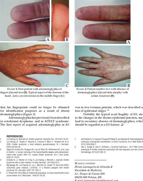 Kindler Syndrome