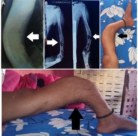 A Left Lower Limb Tibia And Fibula Showing Osteogenesis Imperfecta
