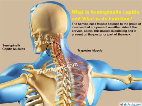 Semispinalis Capitis Strain Or Pain