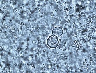 Blastomycosis Oncohema Key