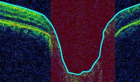 an artificial intelligence based smart system for early glaucoma