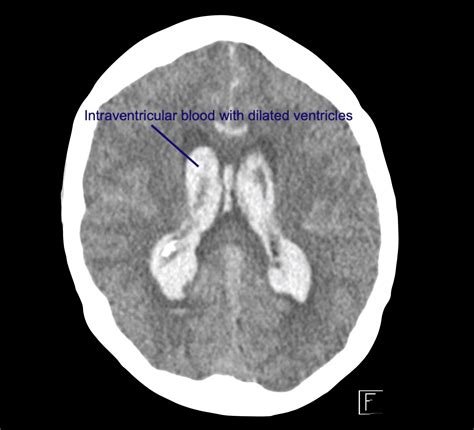 Ct Case 018 • Litfl • Ct Scan Interpretation