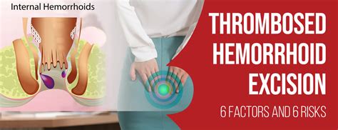 Thrombosed Hemorrhoid Excision 6 Factors And 6 Risks
