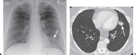 Malignant Neoplasm In Lung At Marilyn Munford Blog