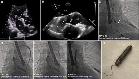 Percutaneous Retrieval Of An Atrial Leadless Pacemaker From The Left