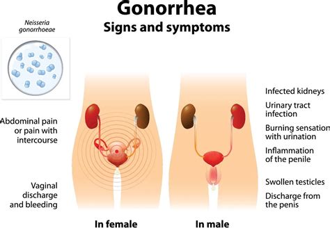 Top 10 Sexually Transmitted Infectionsstis