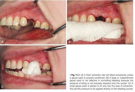 Post Extraction Socket Care Medizzy