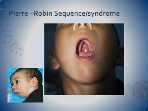 Pierre Robin Sequence Faciodigital Anomaly Syndrome Dzed