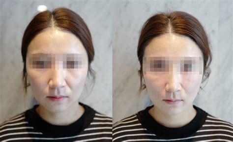 팔자주름실리프팅 의사가 시술한 실제 후기 네이버 블로그