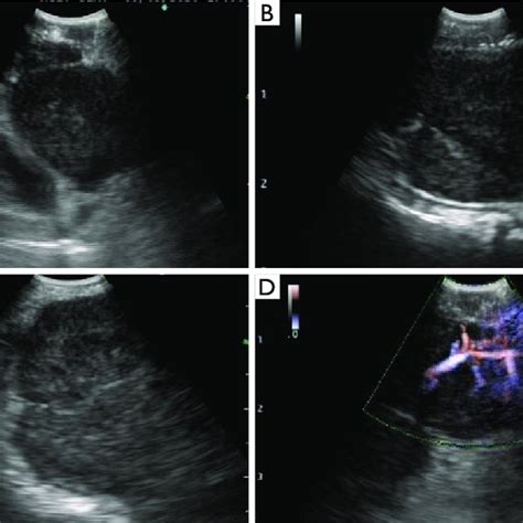 Ecographic Patterns Of Pathological Lymph Nodes The Sonographic Nodes Download Scientific