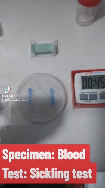 Samuel Simpungwe On Linkedin Sickling Test A Sickle Cell Test Is A