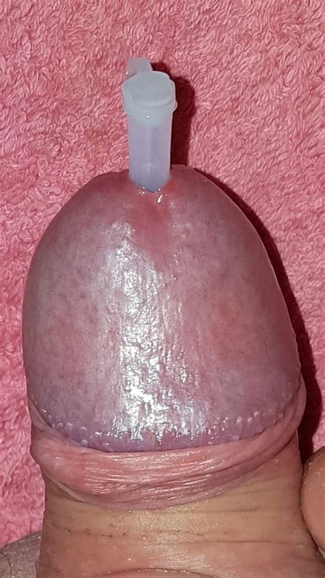 Catheter Insertion 111 Pics 2 Xhamster Catheter Insertion 111 Pics 2 Xhamster