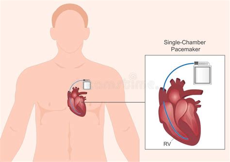 Single Chamber Pacemaker Type Of Pacemaker Stock Illustration Illustration Of Cardioverter
