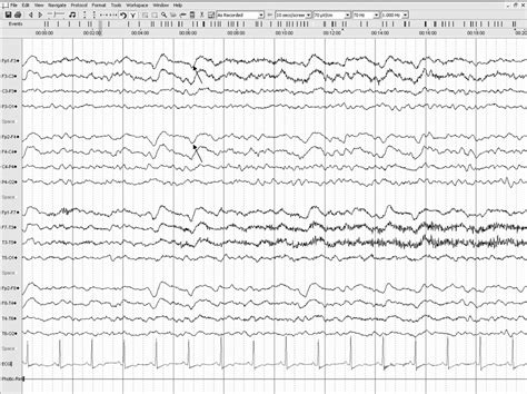 Electroencephalographic Assessment Of Coma Journal Of Clinical