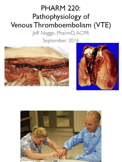 Venous Thromboembolism Vte Pathophysiology September 2016 Pdf Thrombosis Coagulation