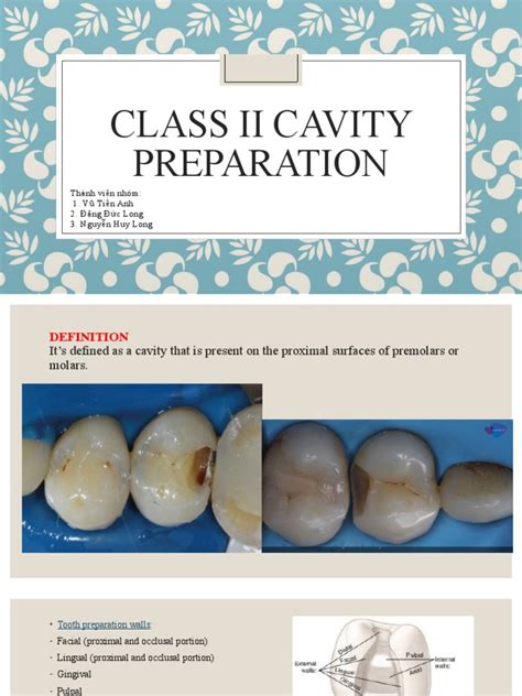 Class Ii Cavity Preparation Pdf Tooth Enamel Tooth