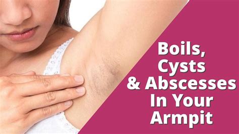 How To Treat Boils Cysts And Abscesses In Your Armpit Lumps In The Armpit Youtube