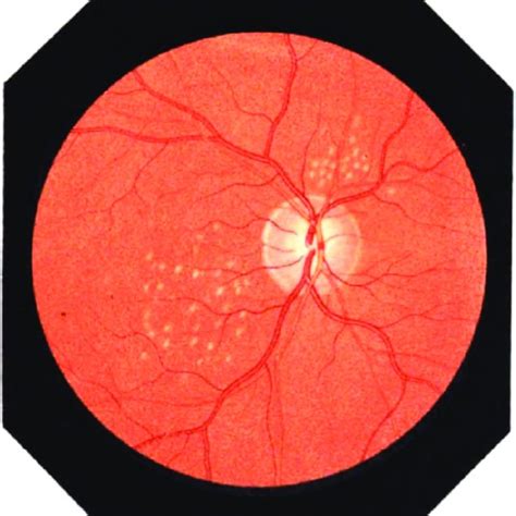First Color Image Of Drusen These Were Called Nodular Exudates In The Download Scientific