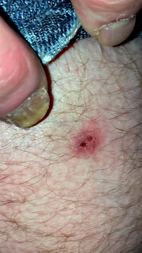 Is This A Bug Bite Rwhatsthisbug