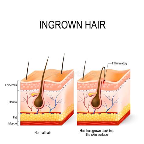 Laser Hair Removal Vector Diagram Stock Vector Illustration Of