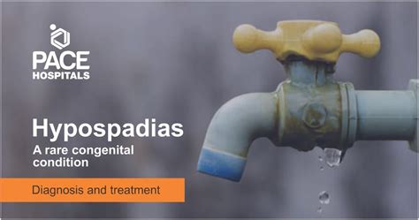 Hypospadias A Rare Congenital Condition Diagnosis And Treatment