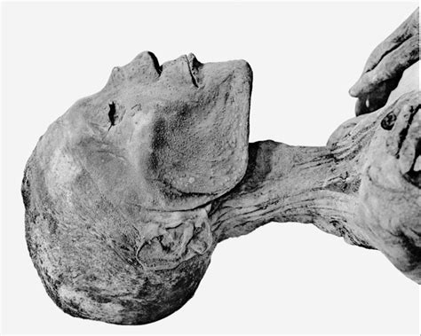 Smallpox Vaccine Scar China At Rebecca Skinner Blog