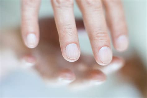 White On Fingernails Deficiency White On Fingernails Deficiency