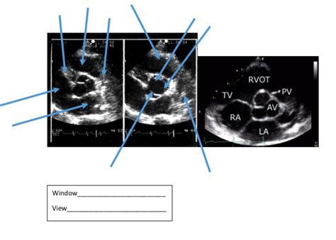 Parasternal Short Axis Aorta Diagram Quizlet
