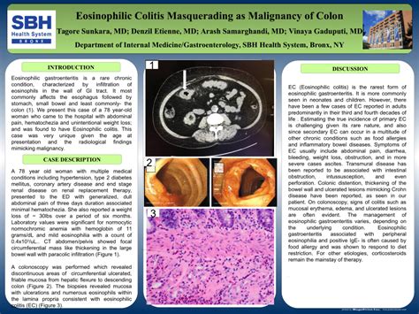 Pdf Eosinophilic Colitis Masquerading As Malignancy Of Colon
