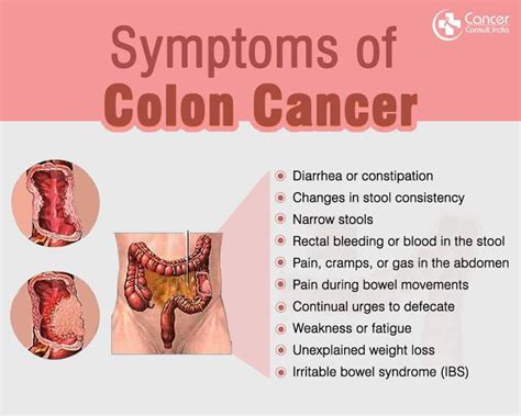 Colon Cancer And Narrow Stools At Amelia Bryant Blog